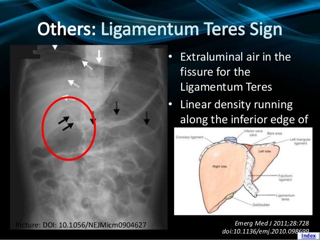 Signs of Pneumoperitoneum on Plain Film