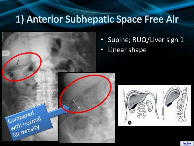 Signs of Pneumoperitoneum on Plain Film