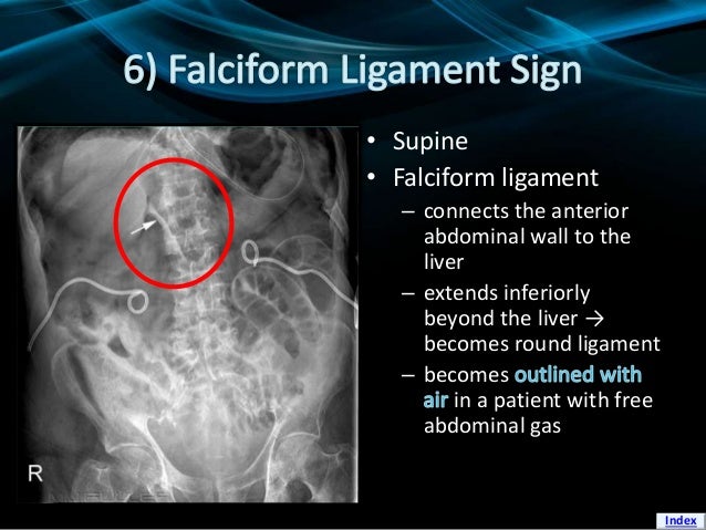 Signs of Pneumoperitoneum on Plain Film
