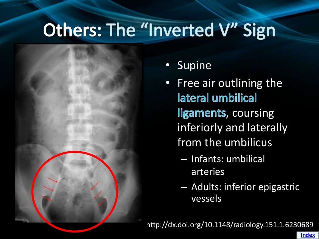Signs of Pneumoperitoneum on Plain Film
