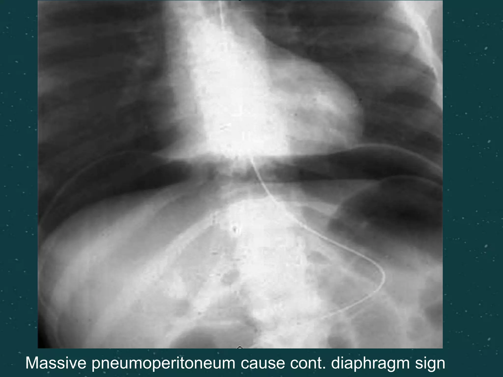 Pneumoperitoneum x ray | PPTX