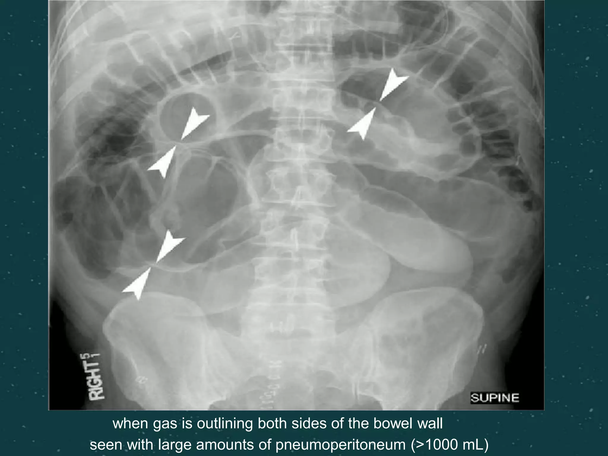 Pneumoperitoneum x ray | PPTX
