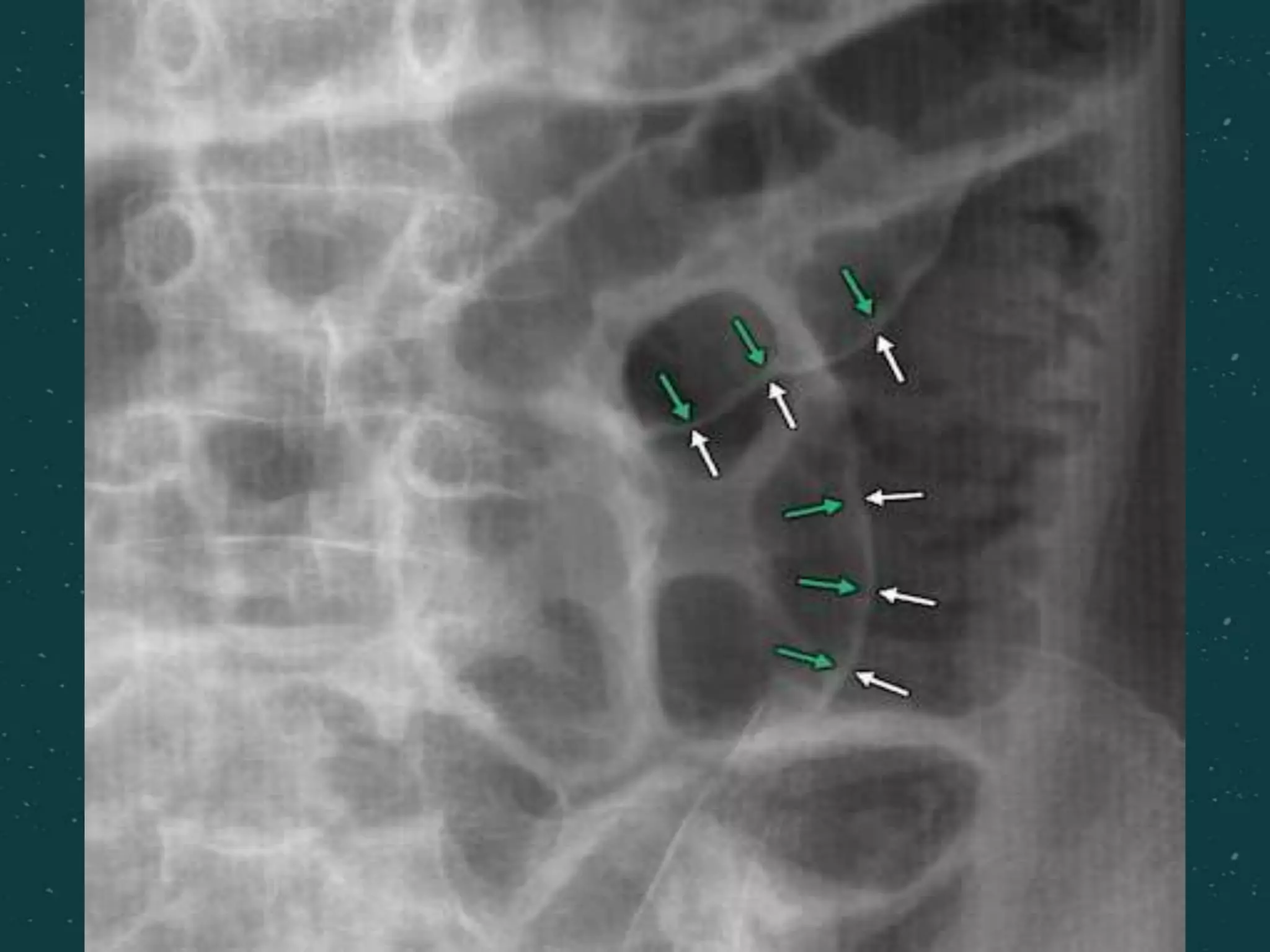 Pneumoperitoneum x ray | PPTX