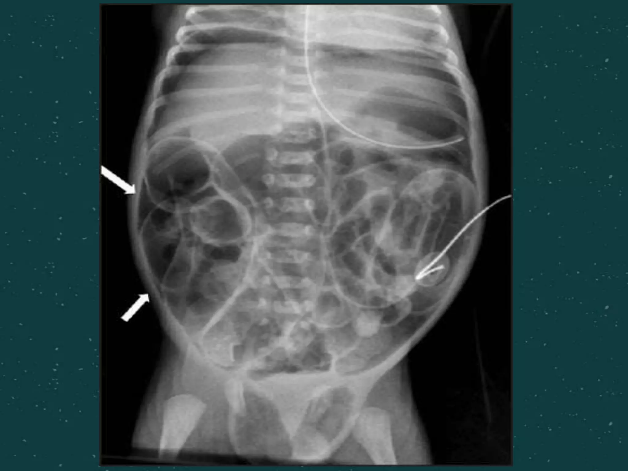 Pneumoperitoneum x ray | PPTX
