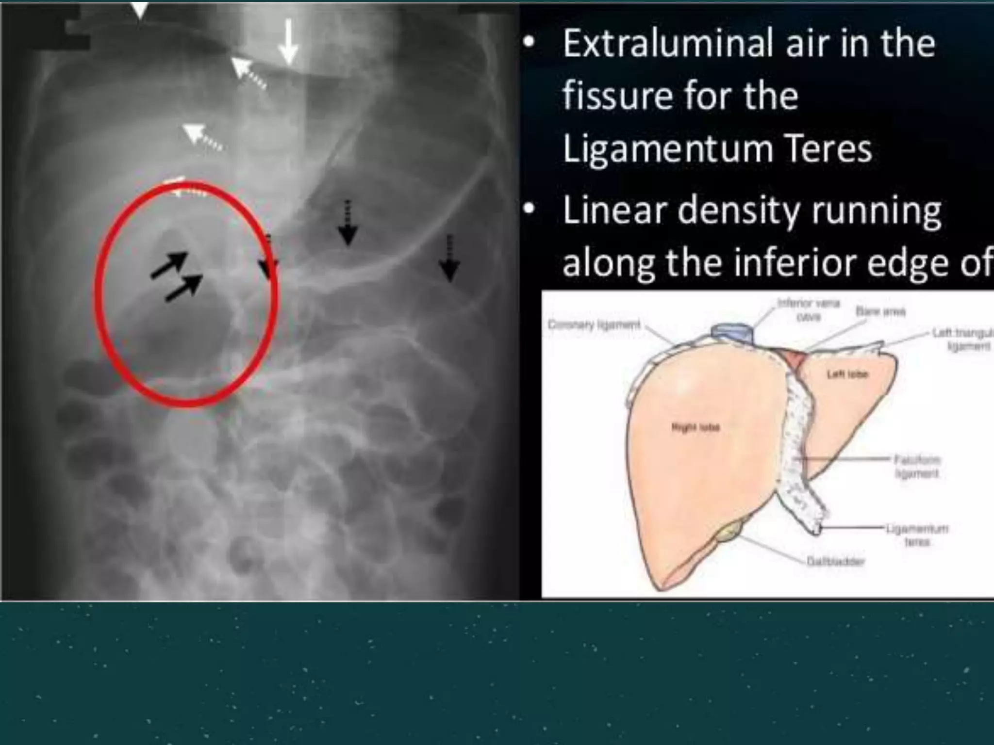 Pneumoperitoneum x ray | PPTX