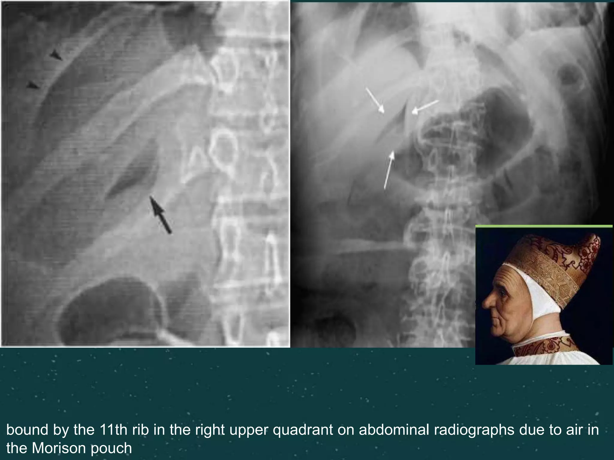 Pneumoperitoneum x ray | PPTX