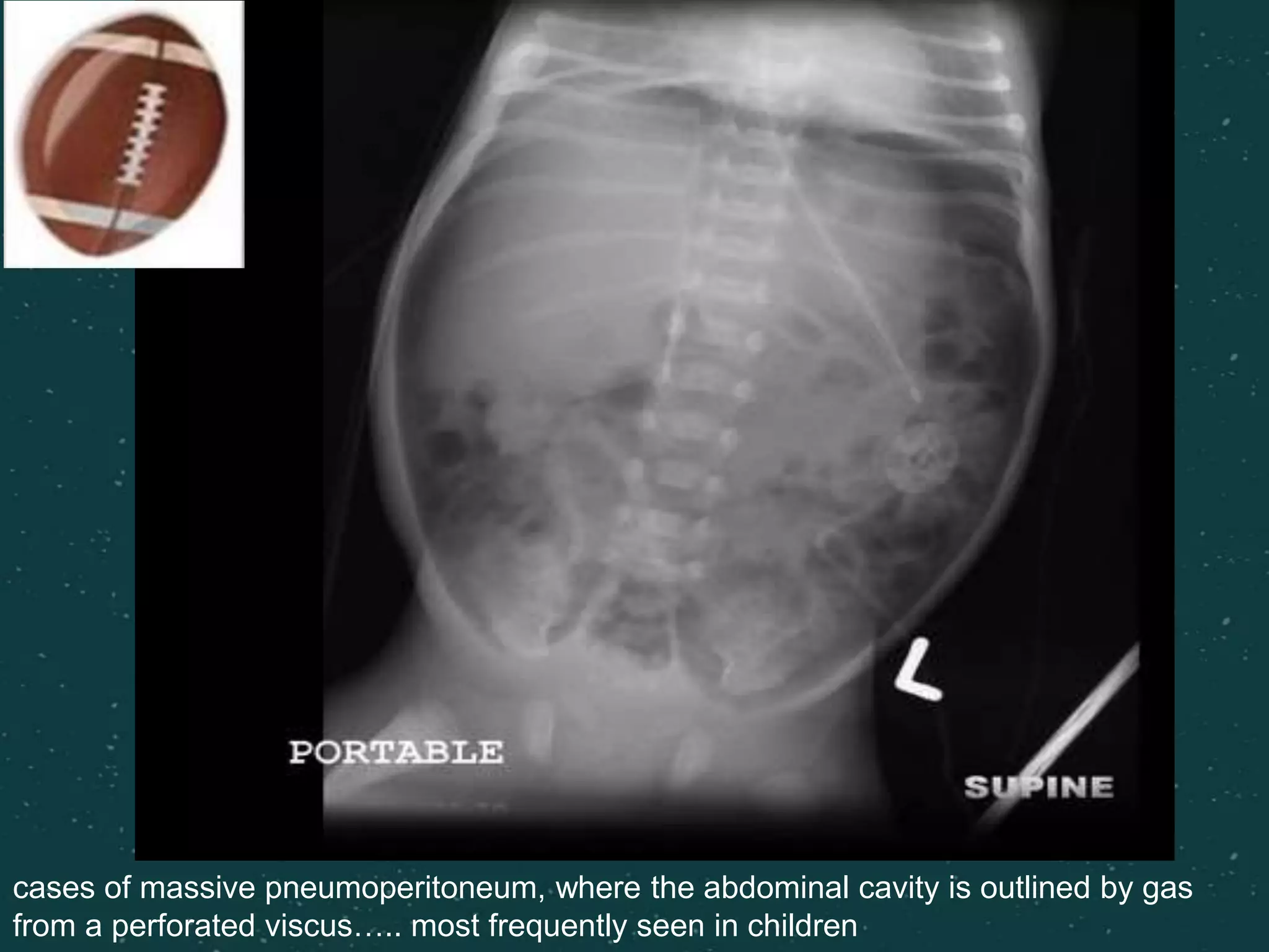 Pneumoperitoneum x ray | PPTX