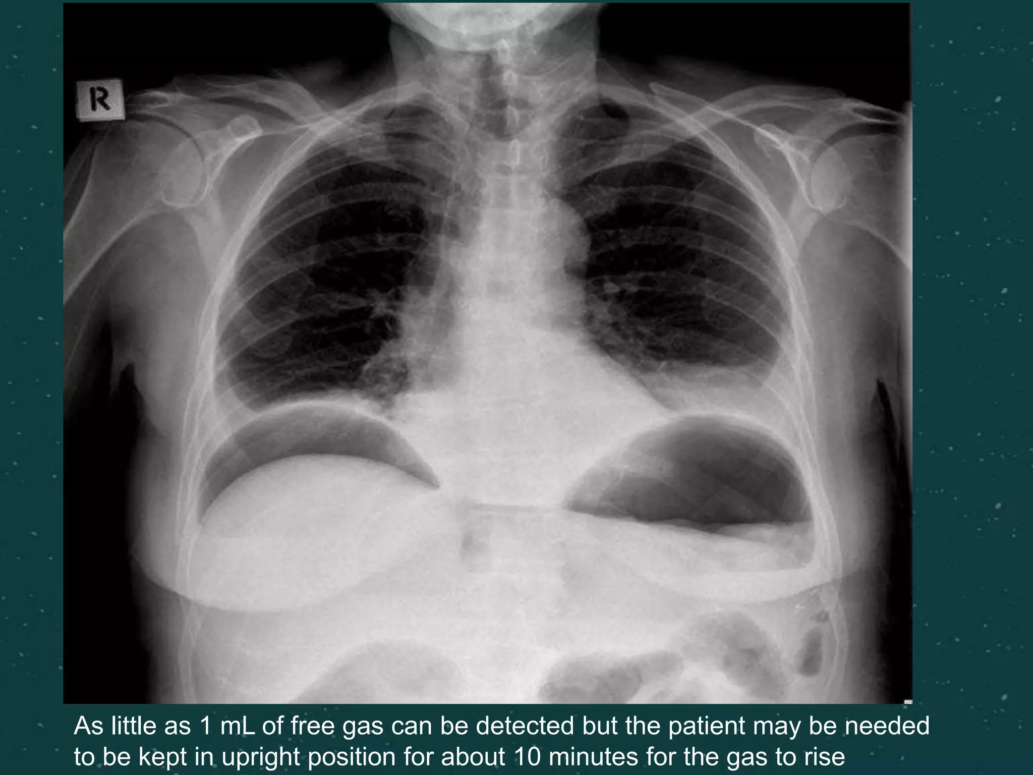 Pneumoperitoneum x ray | PPTX