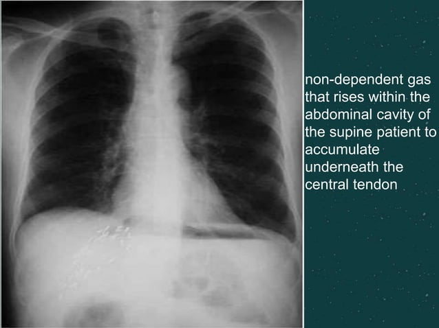 Pneumoperitoneum x ray | PPTX