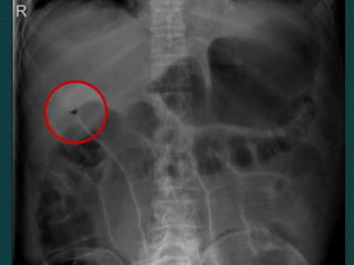 Pneumoperitoneum x ray | PPTX
