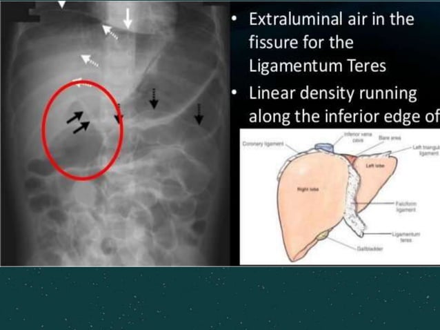 Pneumoperitoneum x ray | PPTX