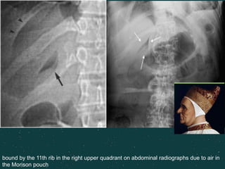 Pneumoperitoneum x ray | PPTX