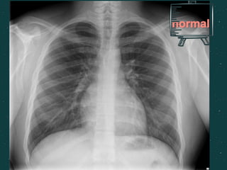 Pneumoperitoneum x ray | PPTX