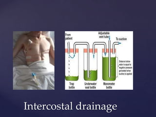 PNEUMOTHORAX fahad basheer | PPT