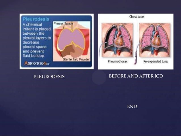 PNEUMOTHORAX fahad basheer
