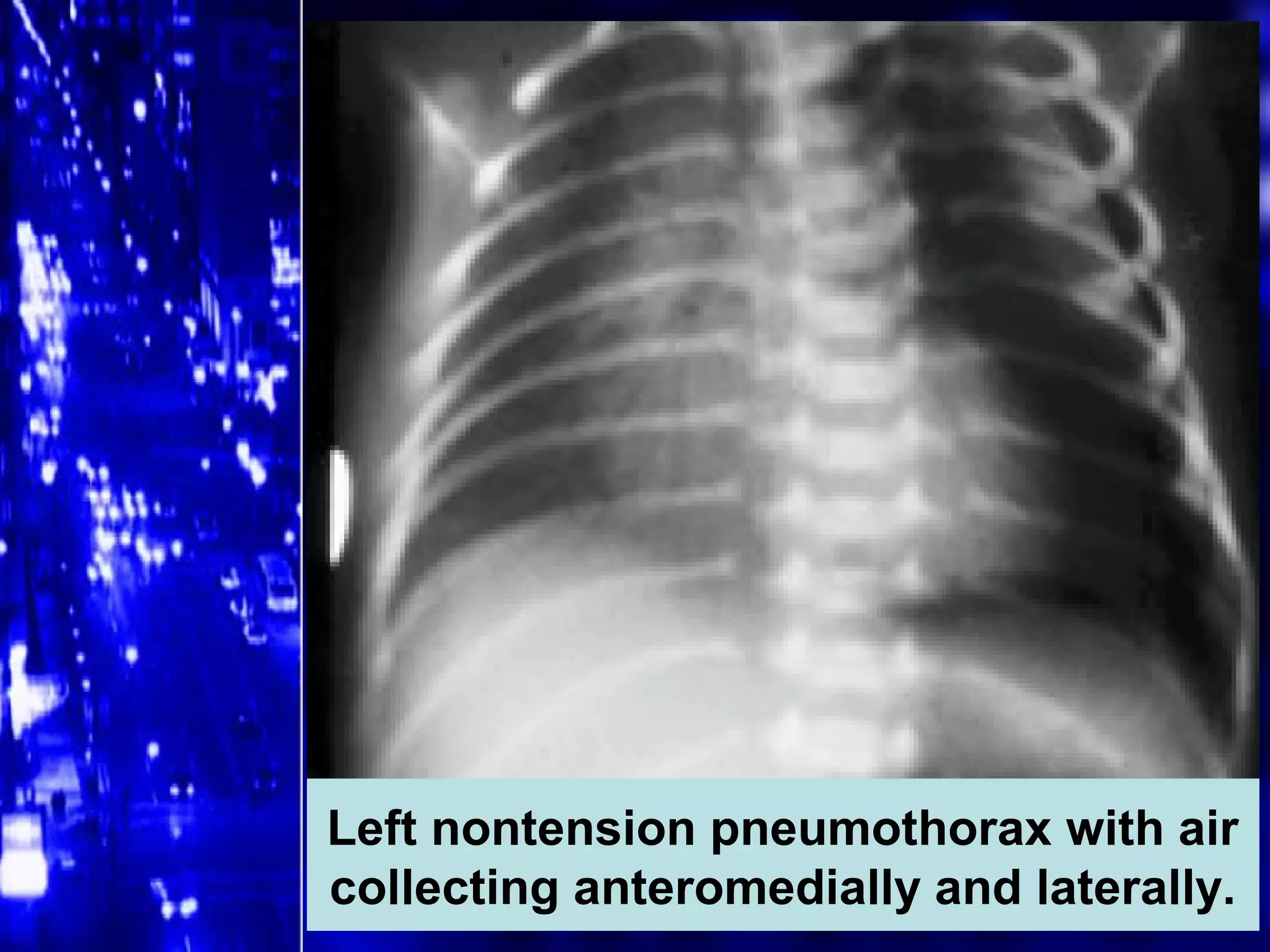 Pneumothorax | PPT