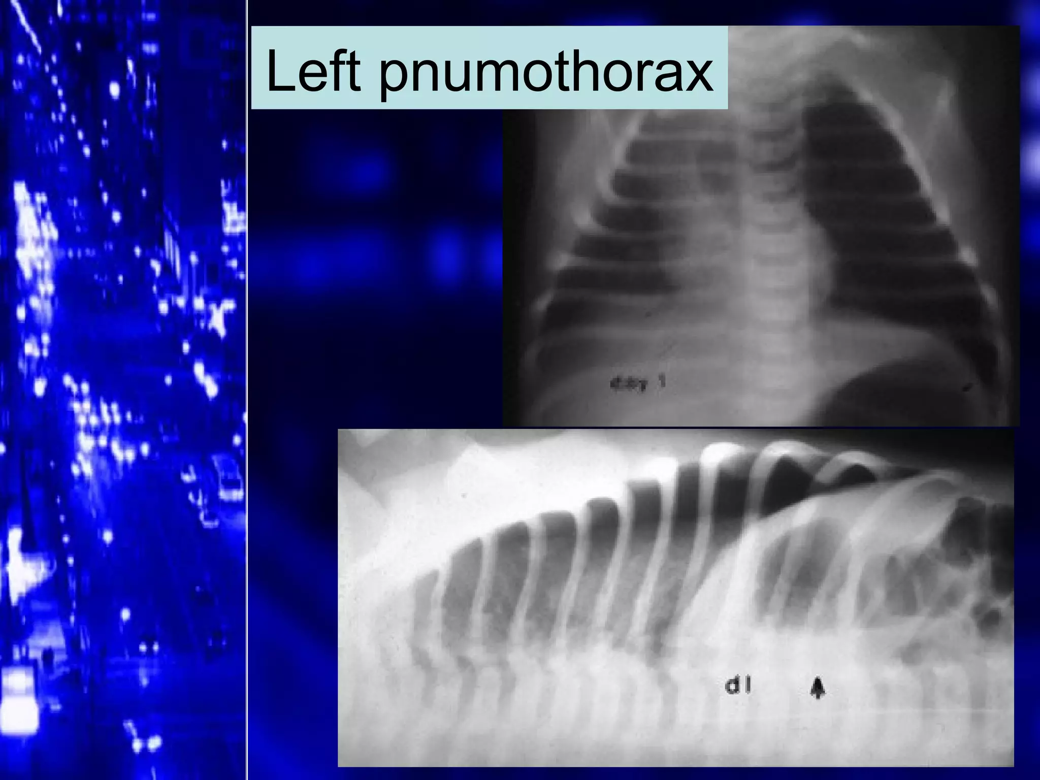 Pneumothorax | PPT