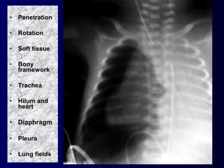 Infant Pneumothorax X Ray