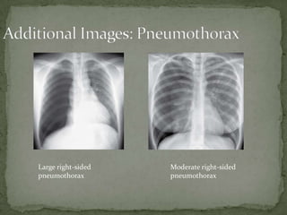 Pneumothorax Power Point | PPTX