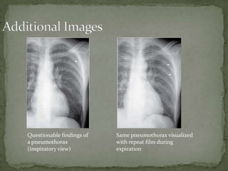 Pneumothorax Power Point | PPTX