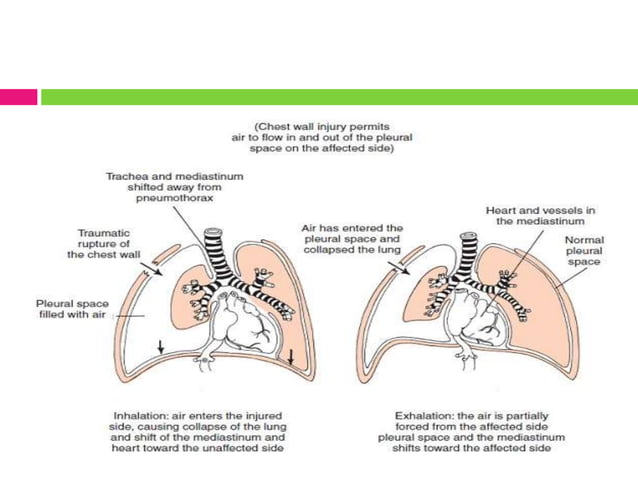 Pneumothorax-A quick Review | PDF | Lung and Respiratory Health ...