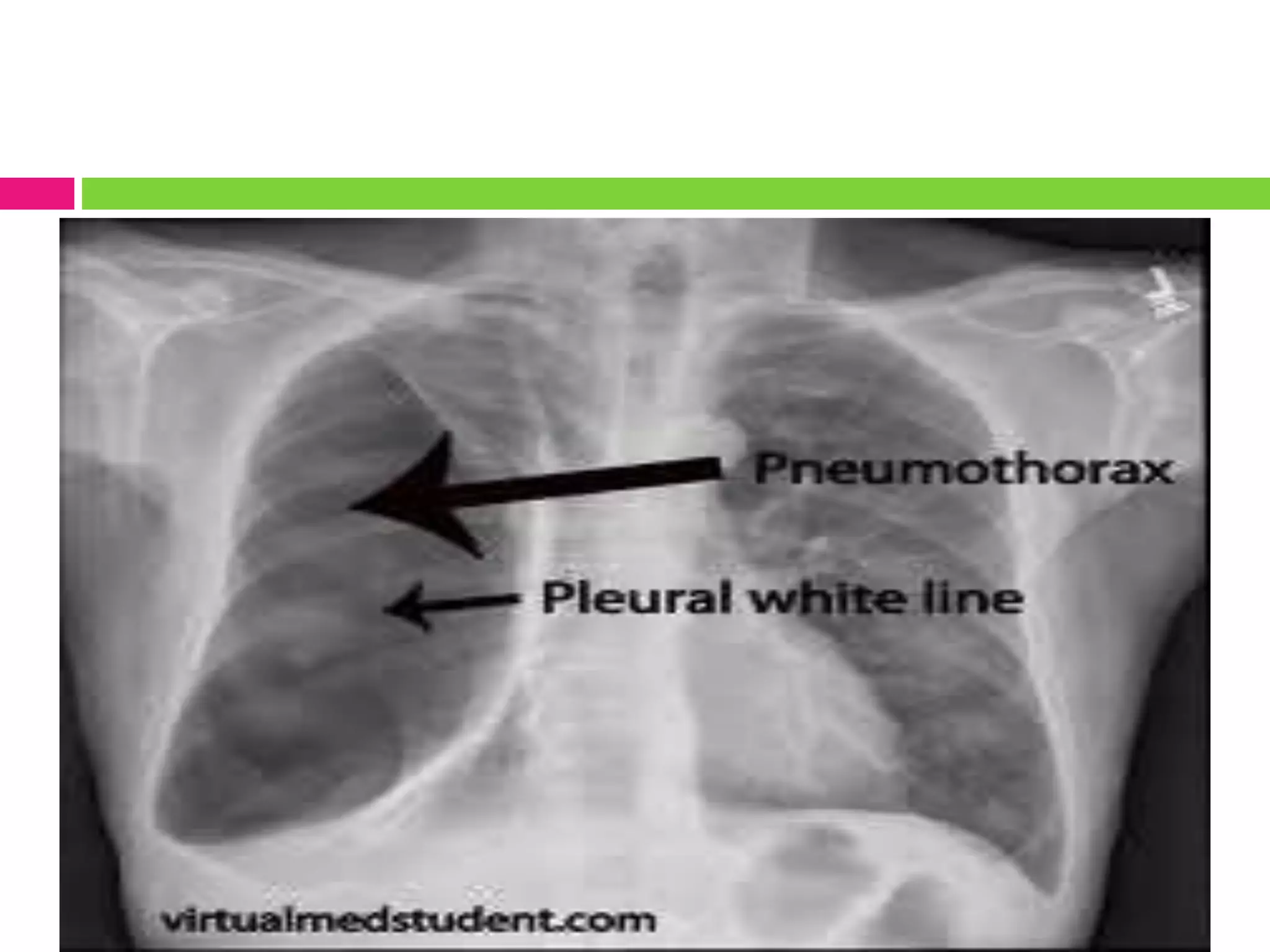 Pneumothorax | PPTX