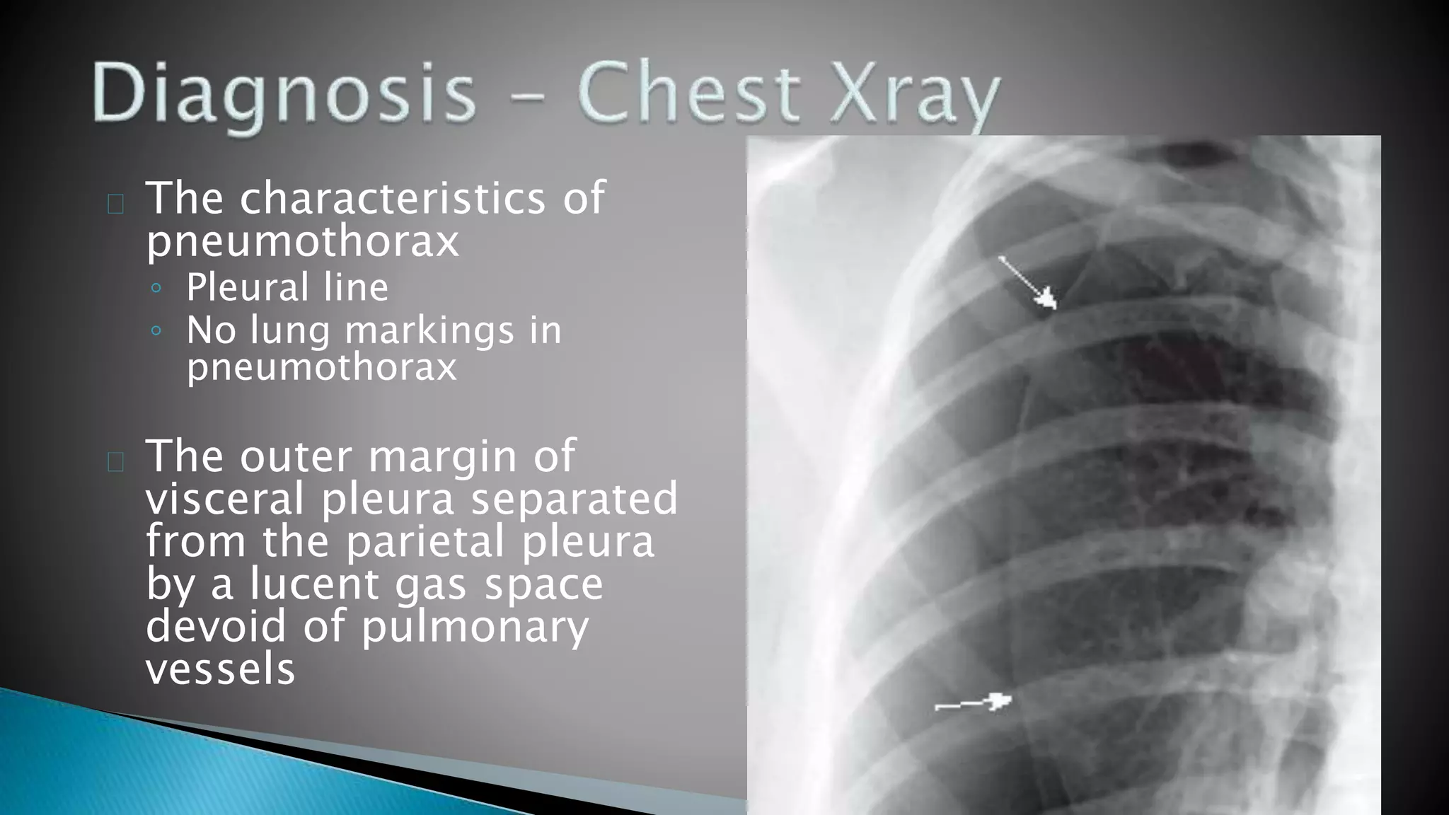 Pneumothorax | PPTX