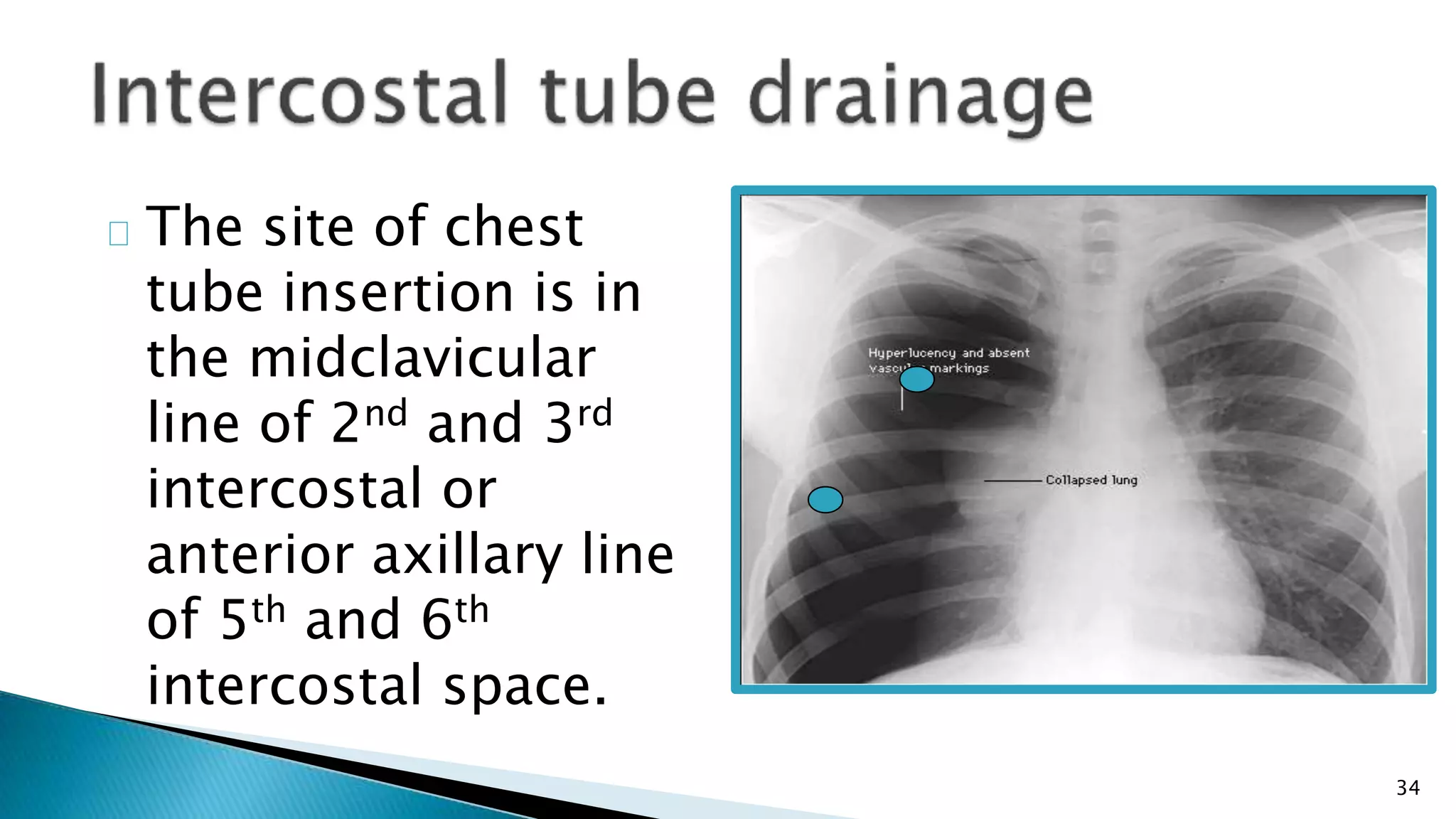 Pneumothorax | PPTX