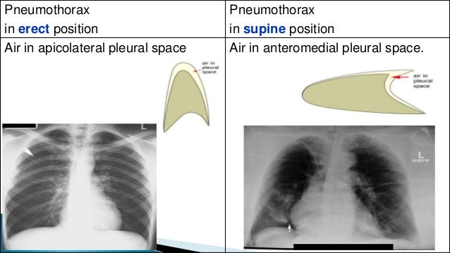 Pneumothorax