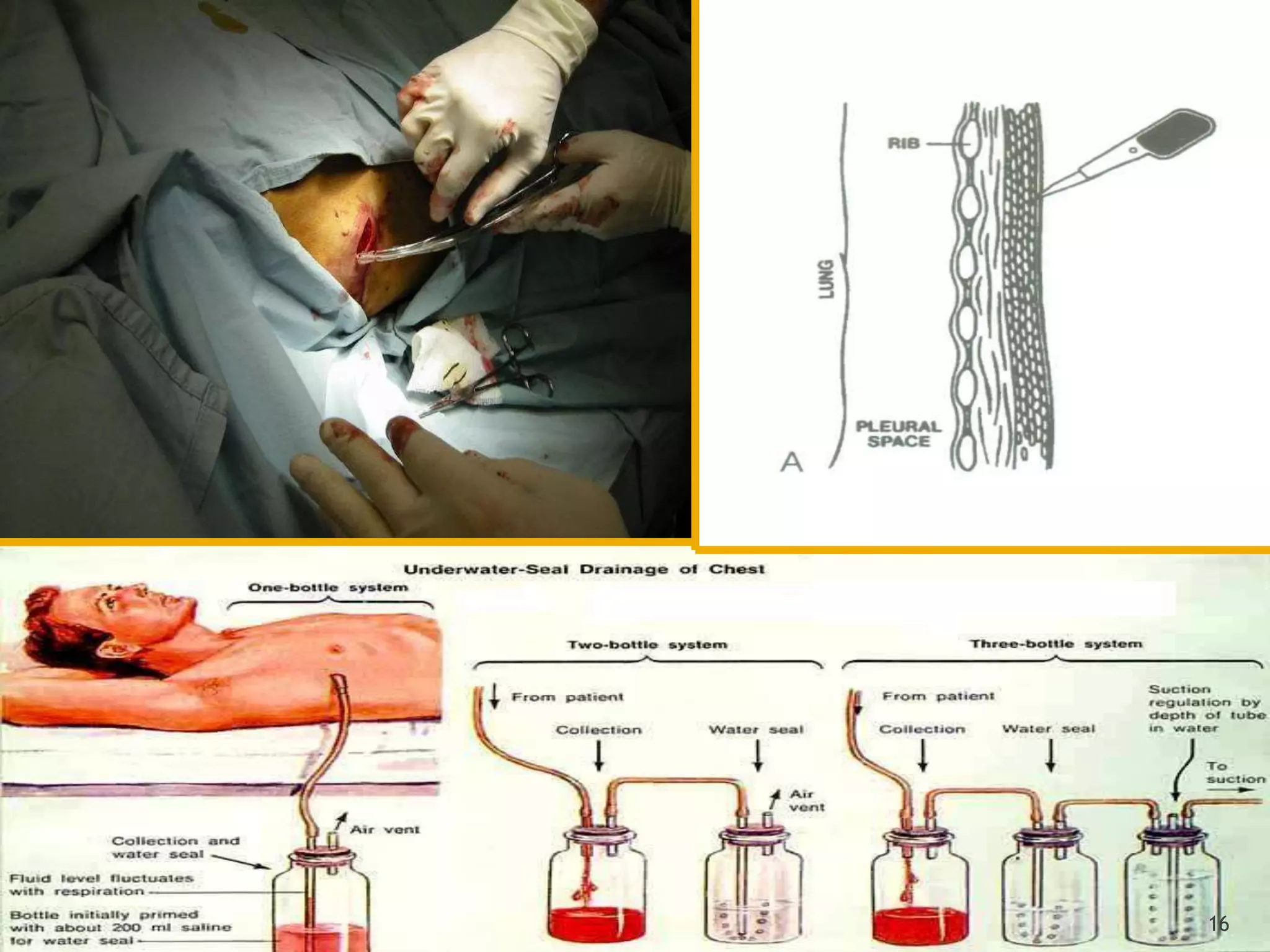 Pneumothorax 141221114833 Conversion Gate02 Pptx