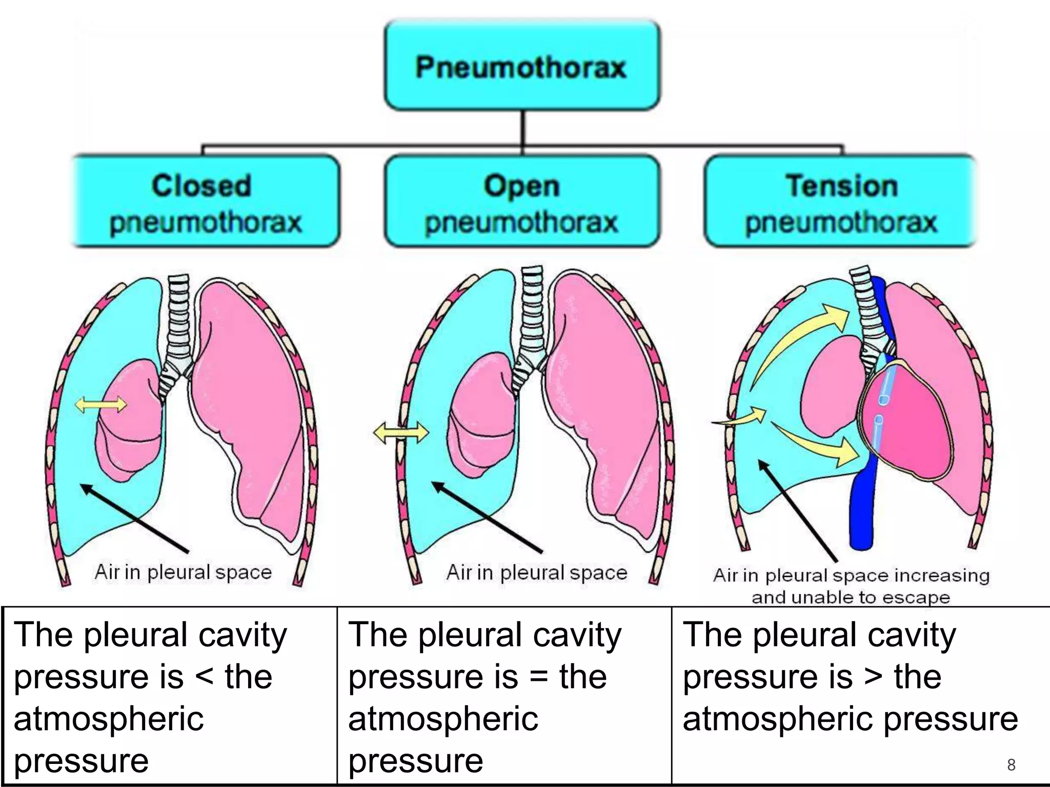 Pneumothorax | PPTX