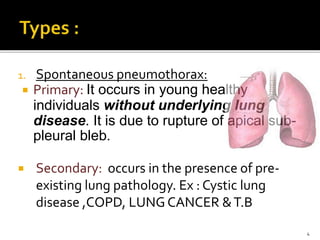 Pneumothorax | PPTX