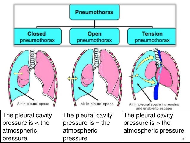 Pneumothorax