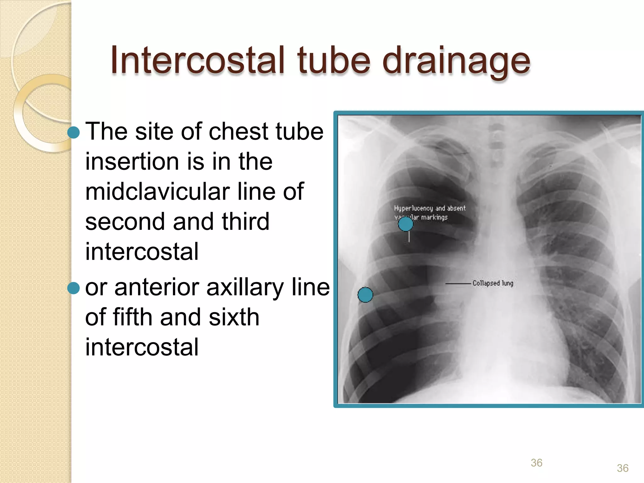 pneumothorax-150828120943-lva1-app6891.pptx