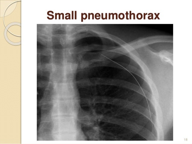 (Pneumothorax
