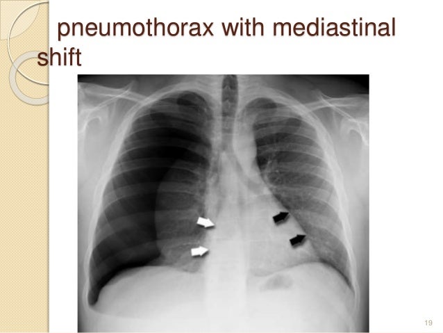 (Pneumothorax