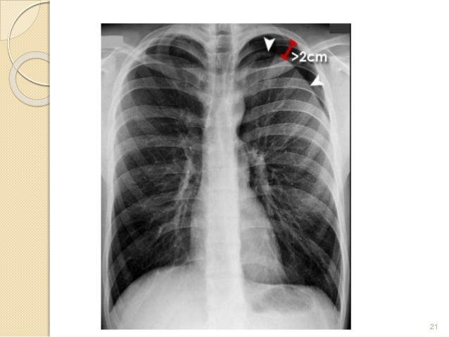 (Pneumothorax