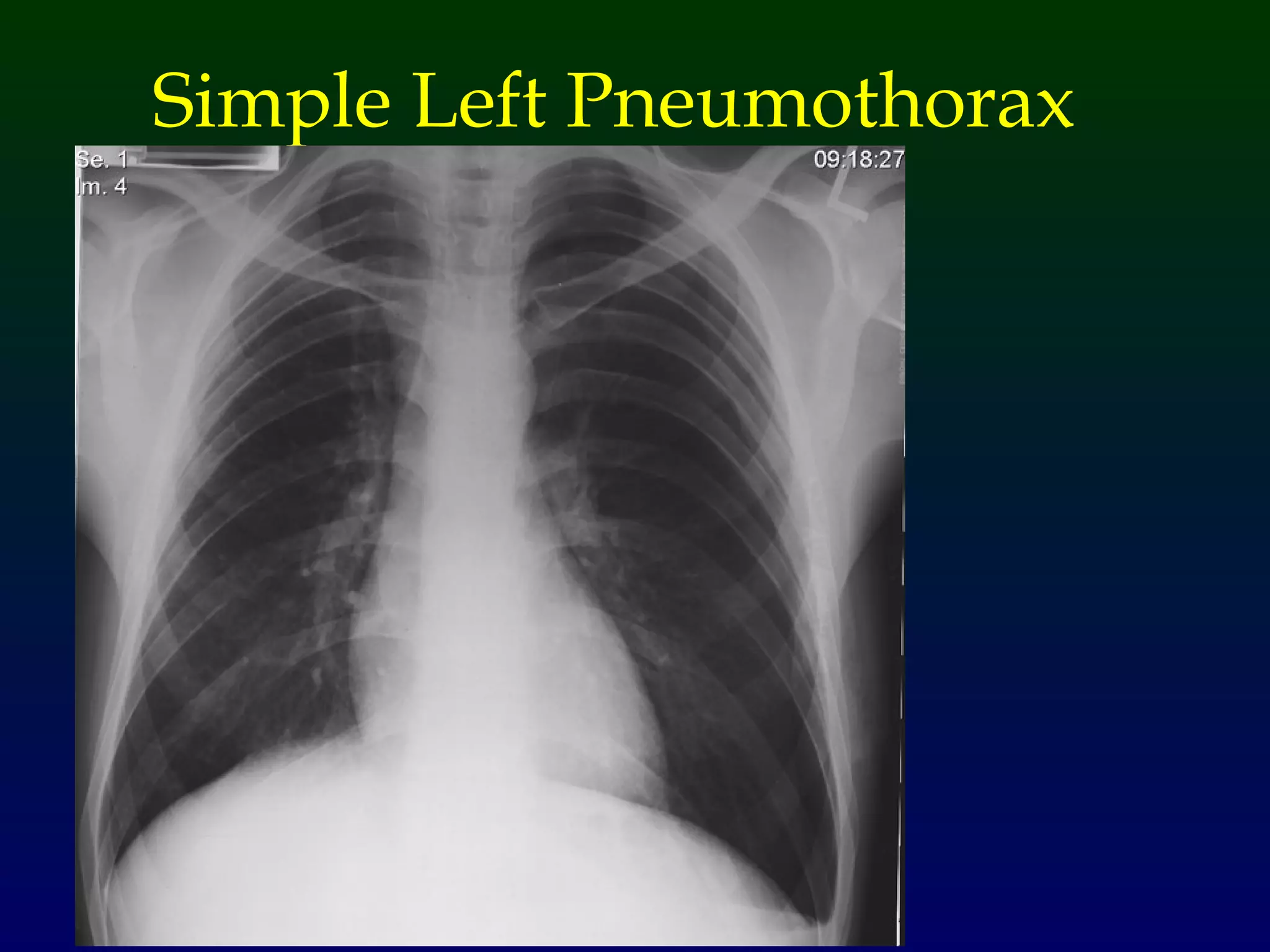 Pneumothorax | PPT