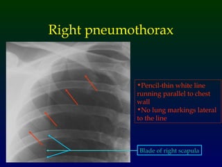 Pneumothorax | PPT