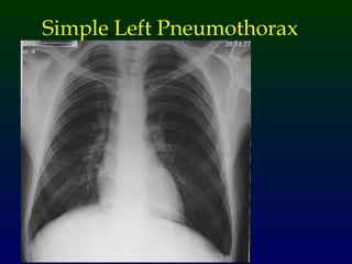 Pneumothorax | PPT