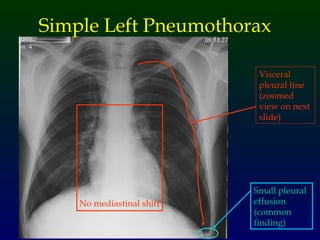Pneumothorax | PPT