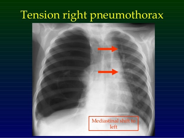 Pneumothorax