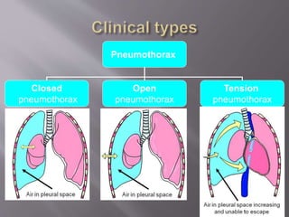 Pneumothorax | PPTX