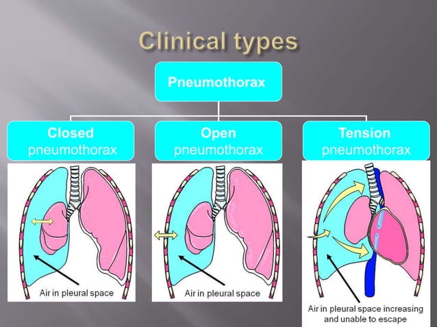 Pneumothorax | PPTX