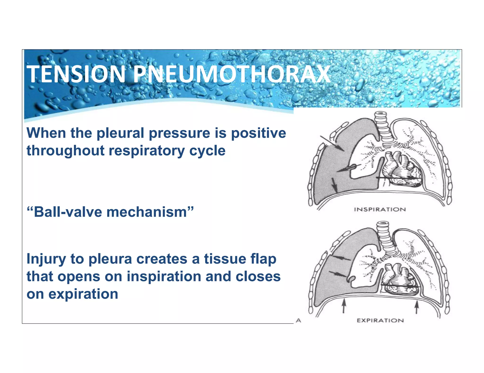 Pneumothorax ..jack