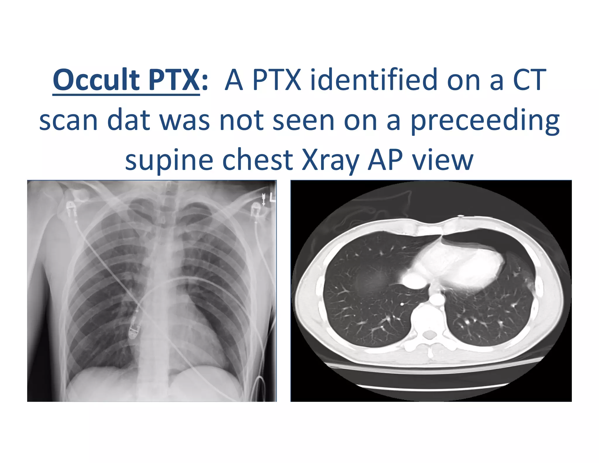 Pneumothorax ..jack