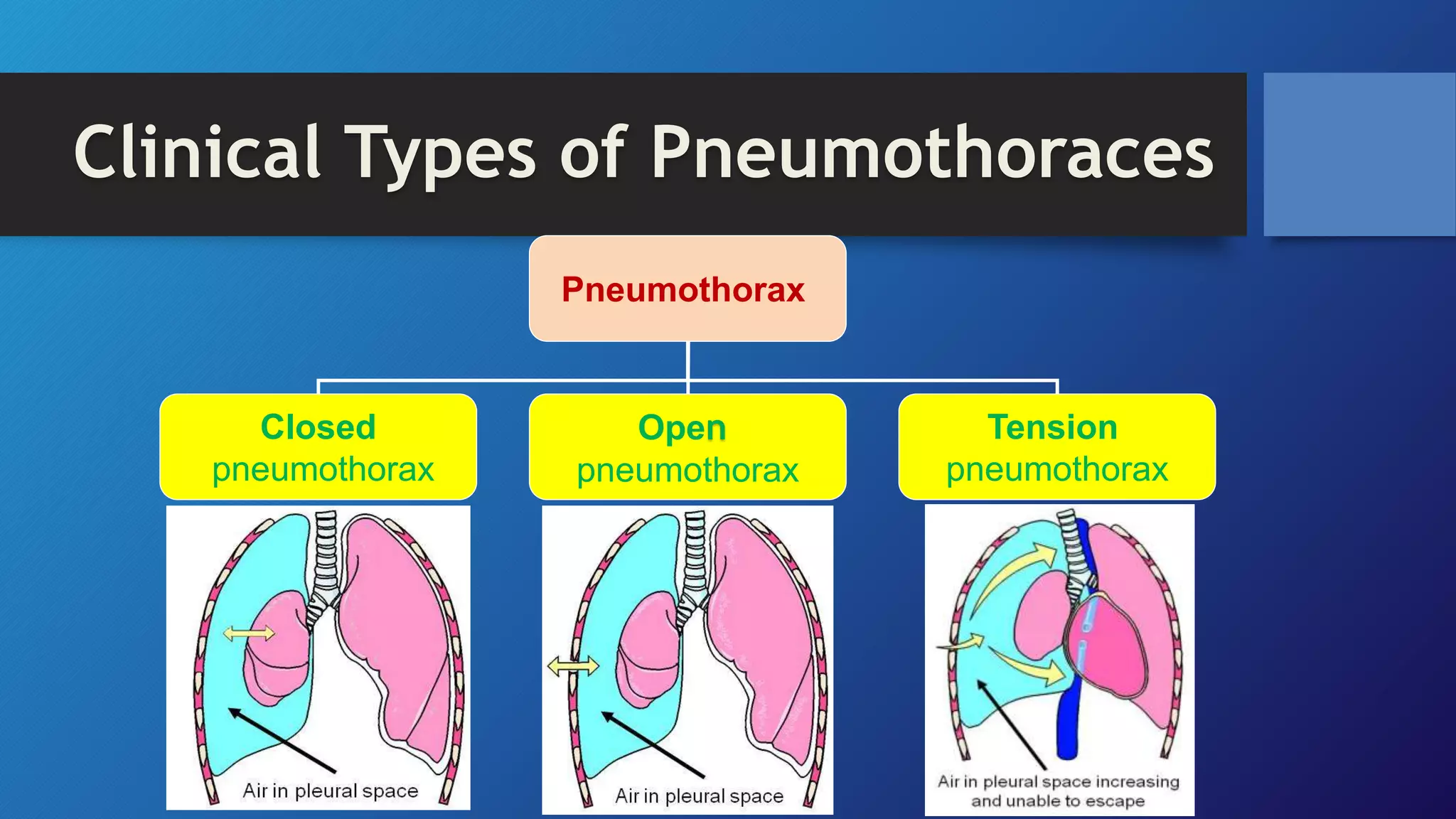 Pneumothorax by Dr. Sookun Rajeev Kumar | PPTX