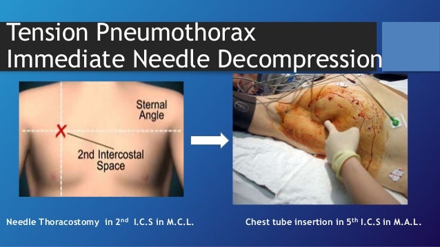 Pneumothorax by Dr. Sookun Rajeev Kumar