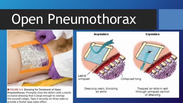 Pneumothorax by Dr. Sookun Rajeev Kumar