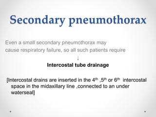 Pneumothorax | PPTX